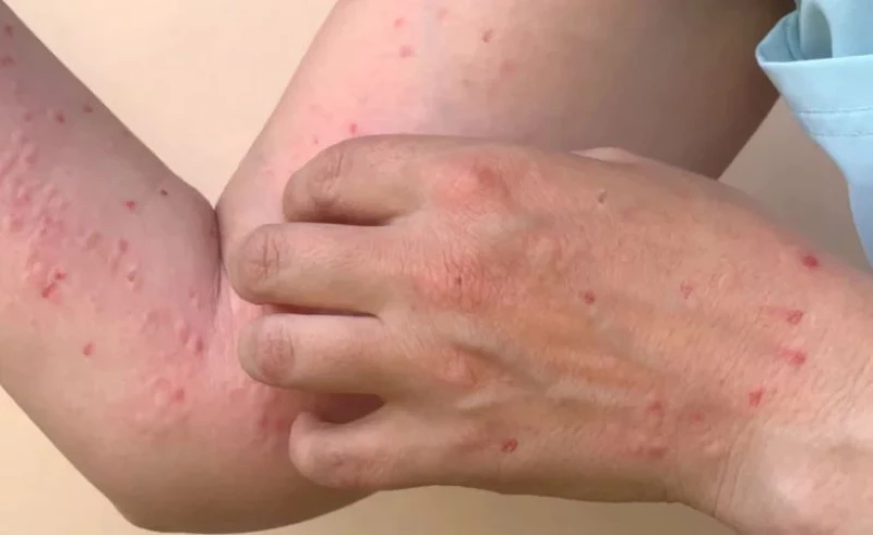 Kuwait On High Alert For Monkeypox Following Case In Jordan | Kuwait ...